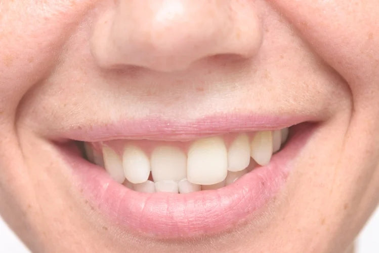Fix Slanted Front Teeth: Get for a Perfect Smile