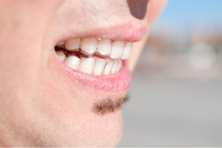 Clear Aligners for Overbite? | Orthodontic Treatment Options