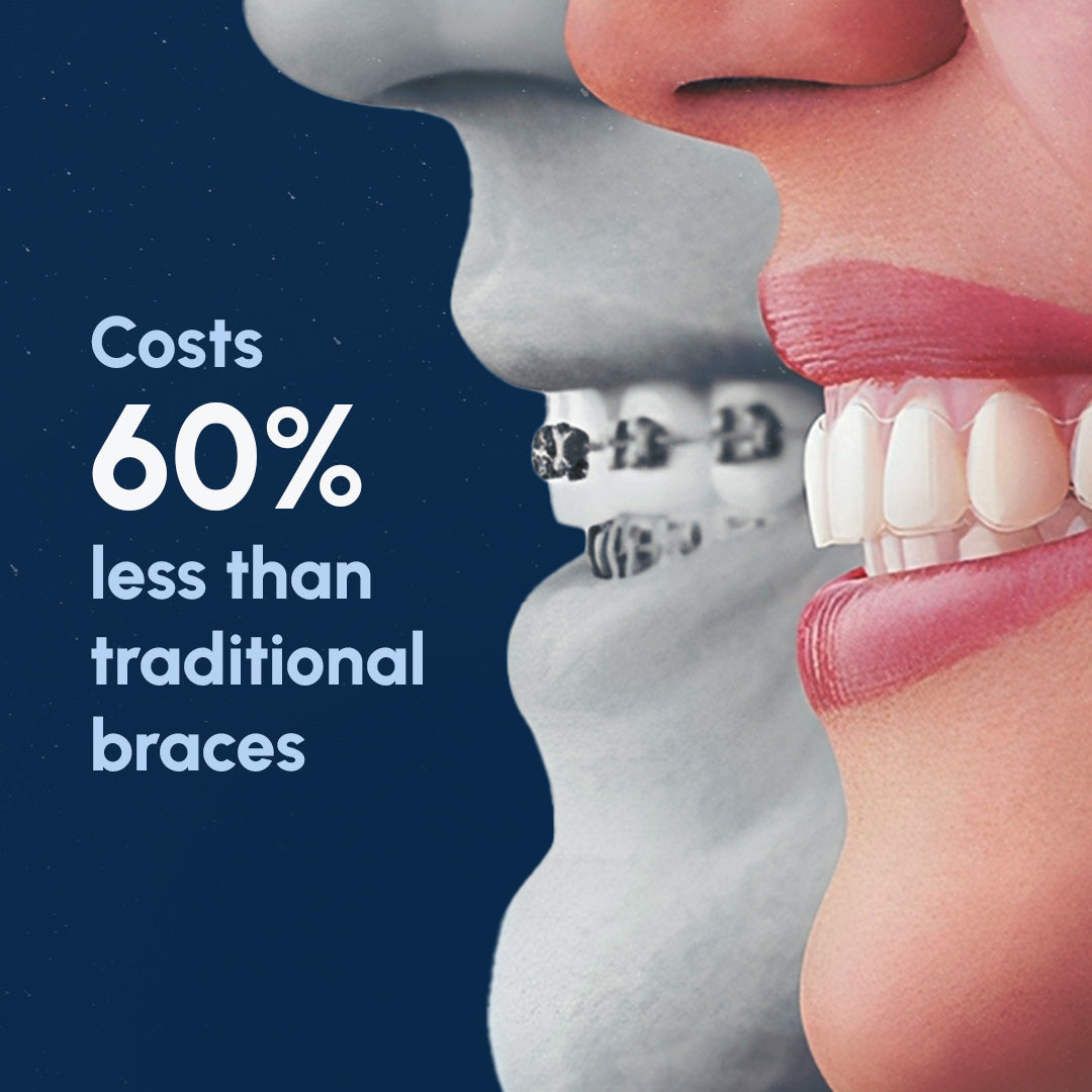 CouplesAdvantage Plan - NightOnly Aligners | Save $740