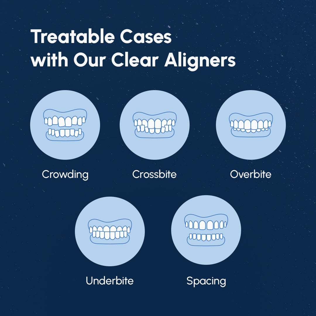 NightFlex Plan – Night Aligners in 12 Easy Payments